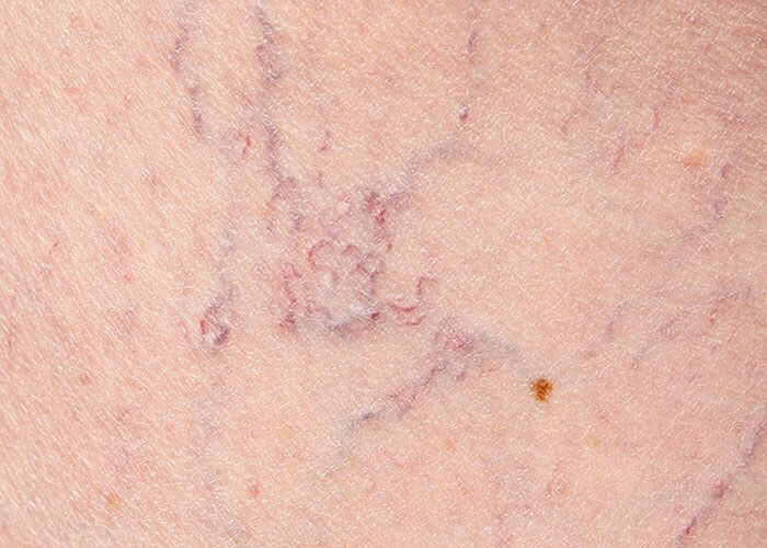Varizes: o que são, como prevenir e como tratar