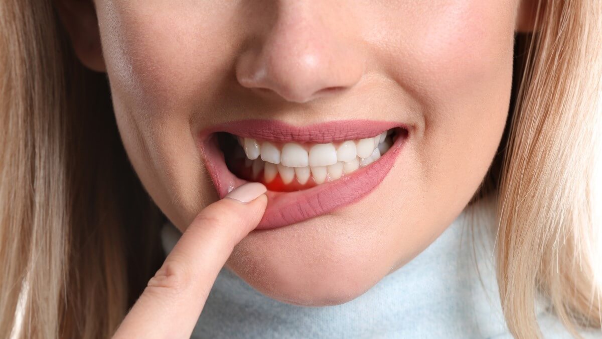 O que é periodontite: causas, sintomas e como prevenir